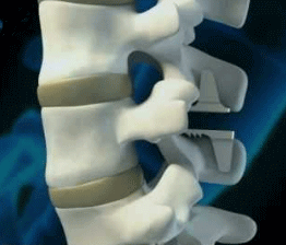 Coflex Spinal Implant & Surgery | Spine Institute Los Angeles