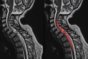 Surgical Options for Spine Tumors