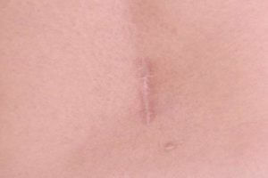 Scar Tissue and Pain After Back Surgery